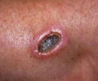 Potential Burn Hazard from General Electric MRIs - Anesthesia Patient ...