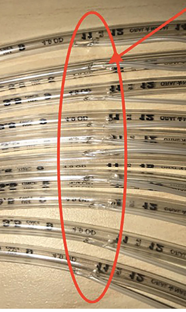 Defective Pediatric Endotracheal Tubes (ETTs) - Anesthesia Patient ...