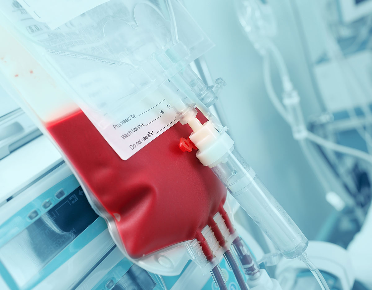 Acute Citrate Toxicity Linked to Excess Citrate-Phosphate-Dextrose ...