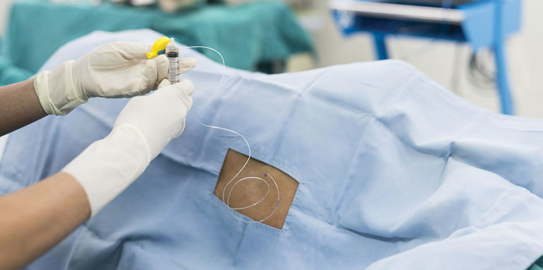 PRO and CON: Using a Labor Epidural for Cesarean Delivery - PRO: Dose ...