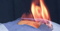 Surgical Fire Prevention: A Review - Anesthesia Patient Safety Foundation