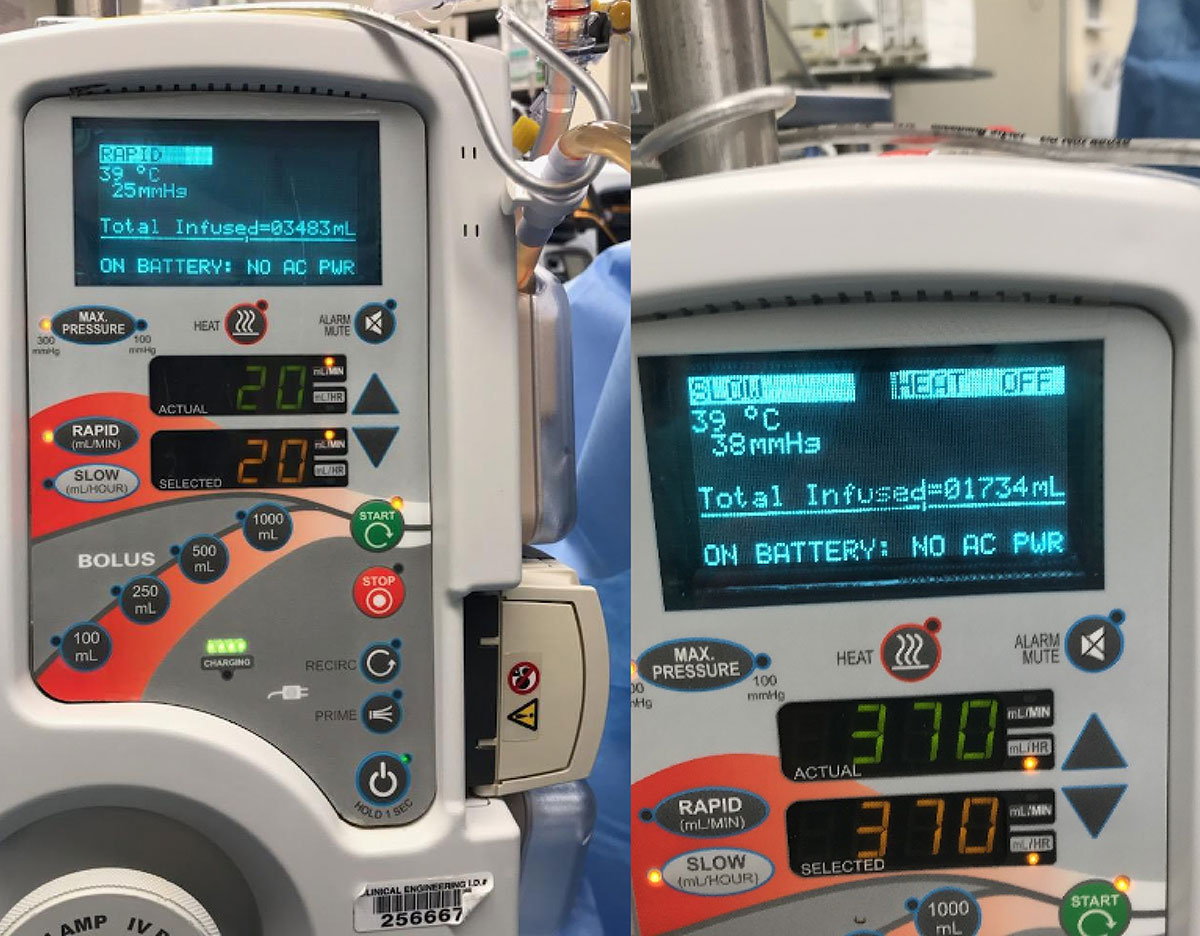 Inadvertent Unplugging of Rapid Infuser Causing a Large Volume of Cold ...