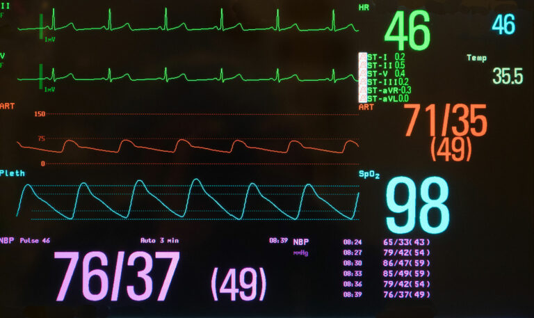 Perioperative Hypotension - Anesthesia Patient Safety Foundation