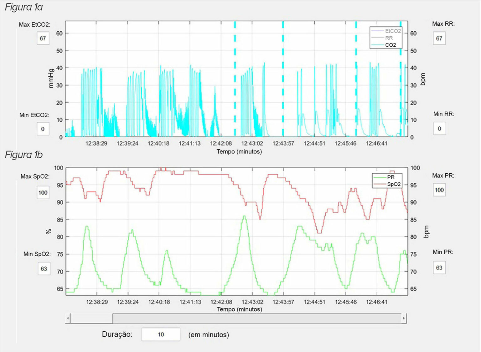 Depressão respiratória induzida por opioides: além dos distúrbios ...