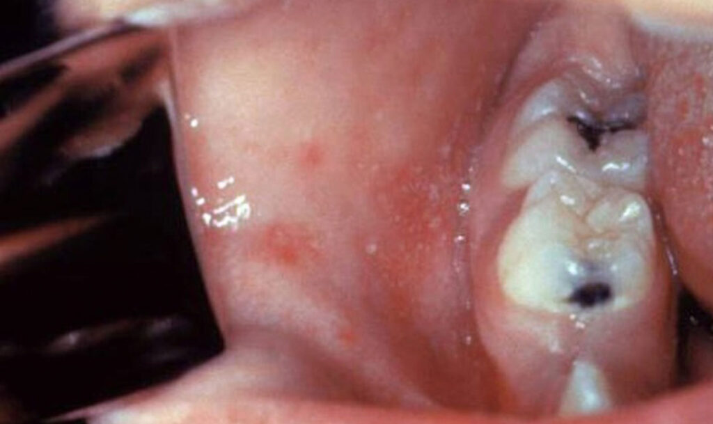 Perioperative Management and Infection Control for Patients with ...