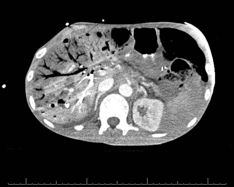 Venous Air Embolism During Endoscopic Retrograde ...