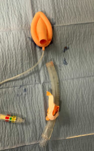 When the Supraglottic Airway Device is the Problem, not the Solution! - Anesthesia Patient ...