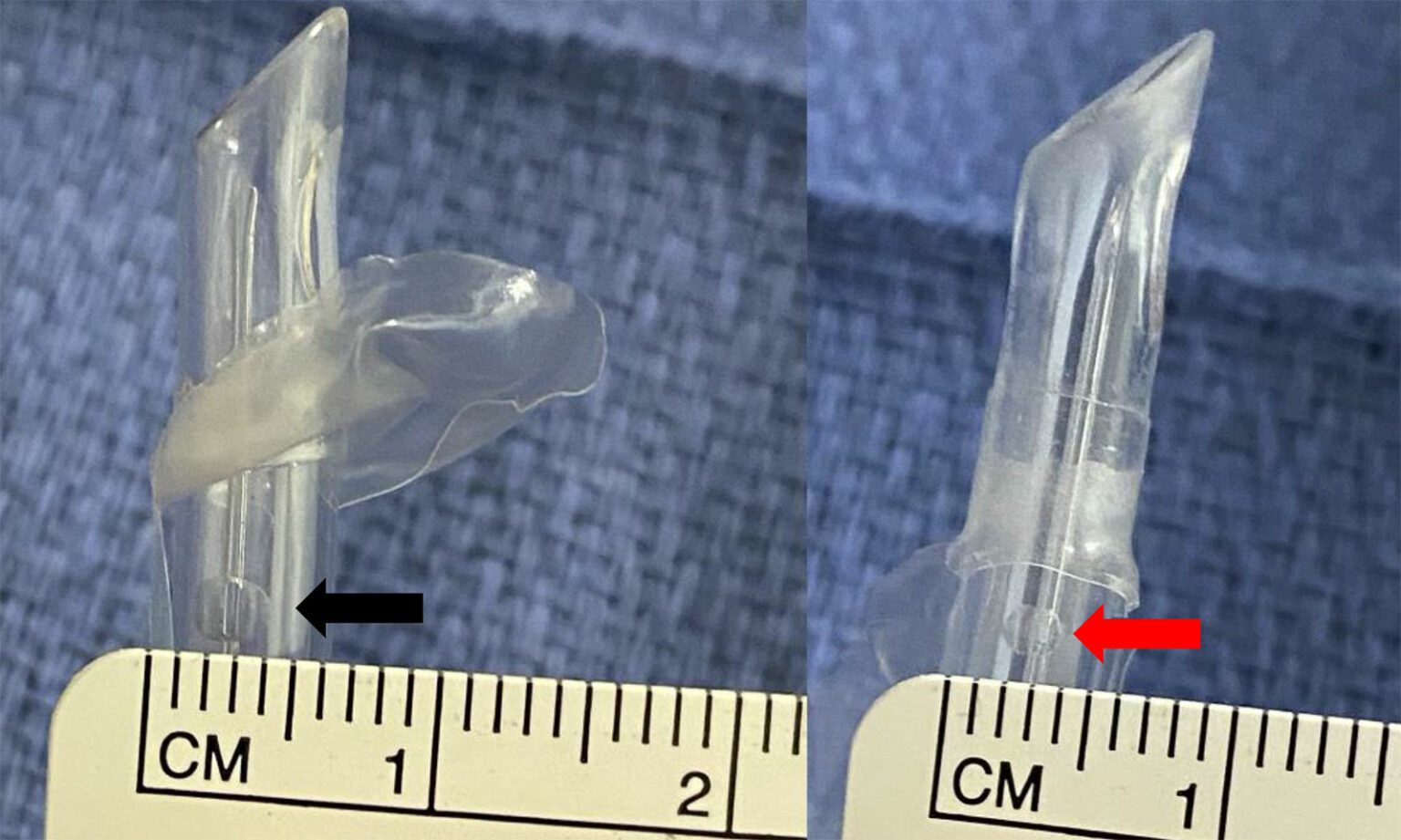 Unusual Cause of Endotracheal Tube Cuff Inflation Failure - Anesthesia ...