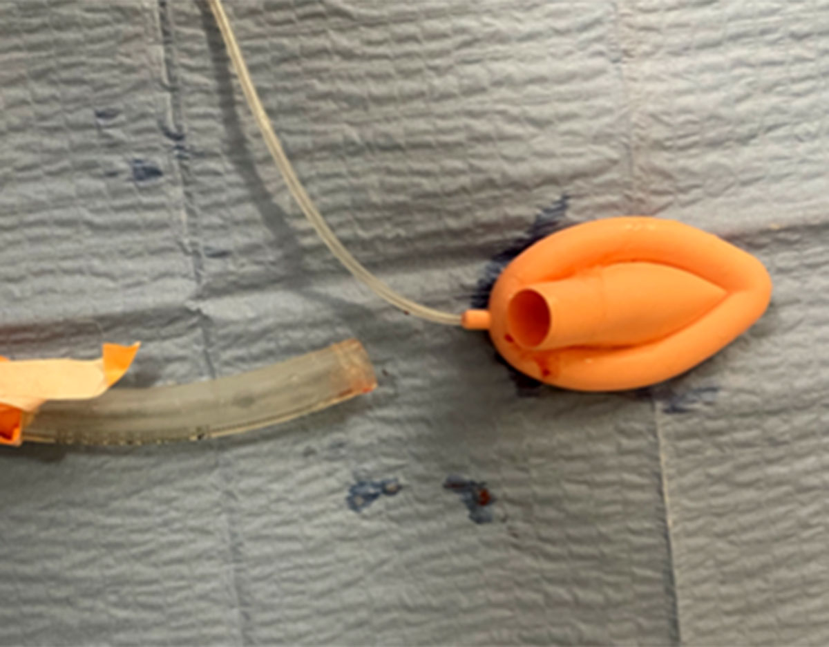 When the Supraglottic Airway Device is the Problem, not the Solution ...